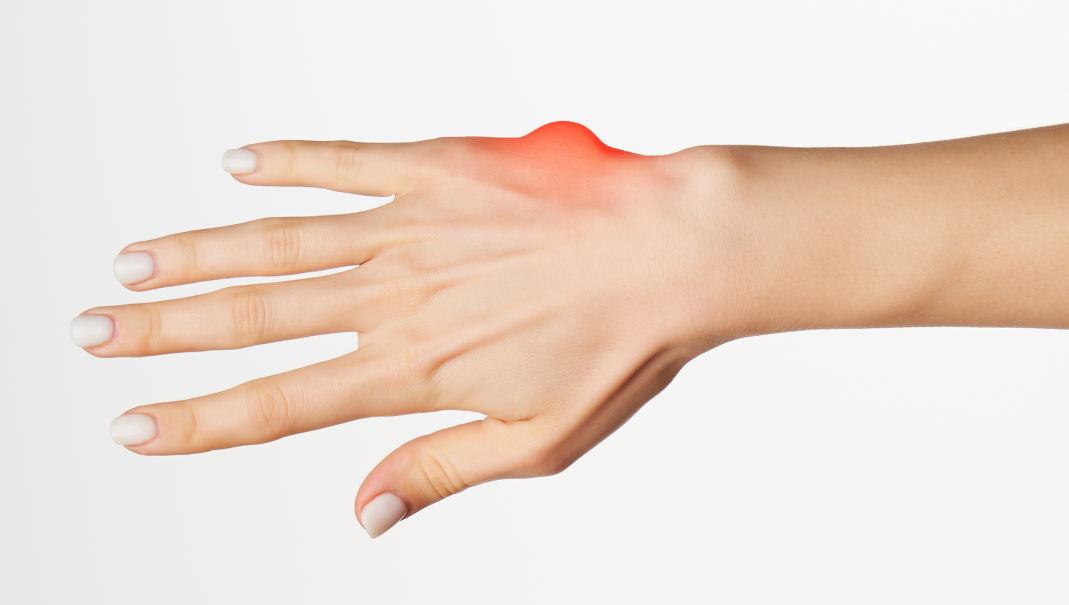 Hand Tumor Treatment | Hand Tumor Surgery In Dubai - Dr. Robert Hiener