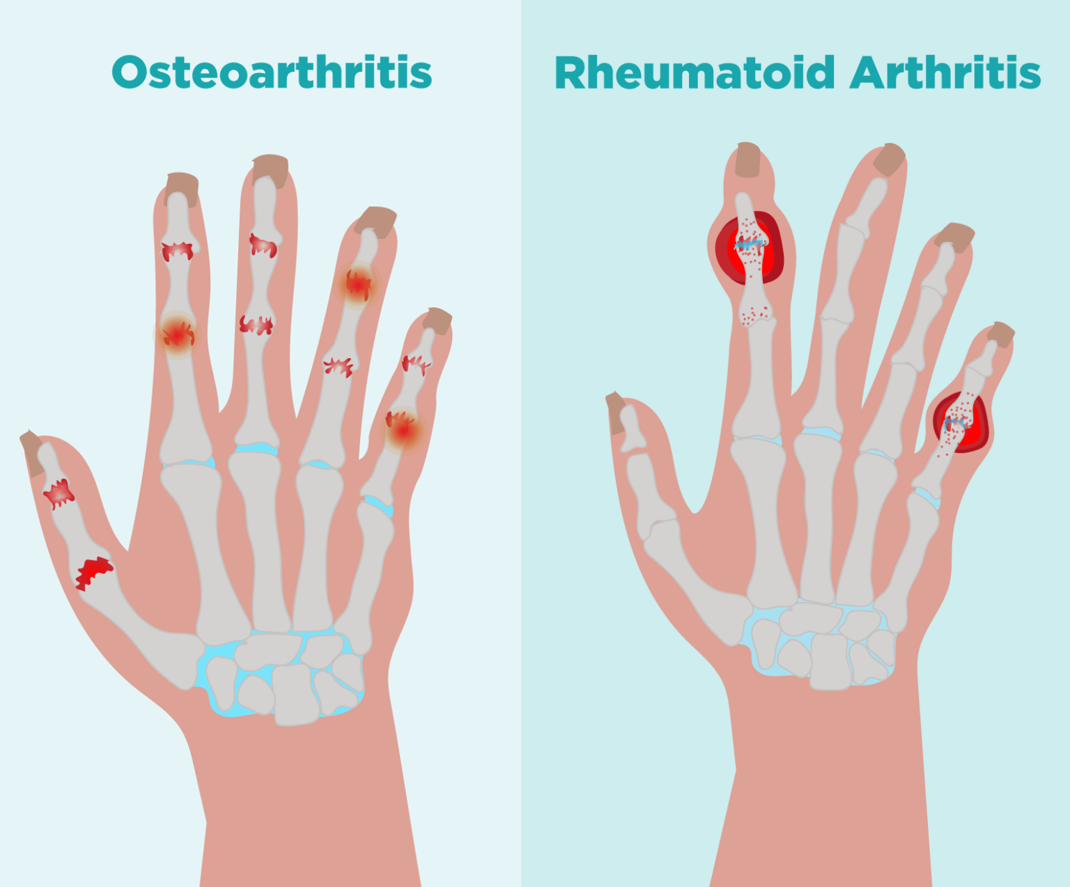 Rheumatoid Arthritis Vs Osteoarthritis - Prof Dr. Robert Hierner