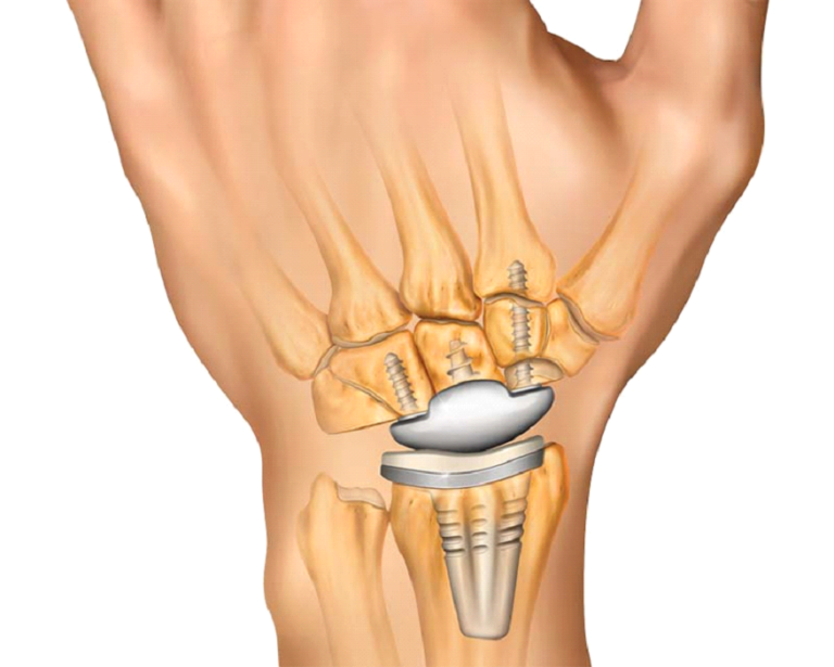 Total Joint Replacement At The Wrist And Hand - Prof Dr. Robert Hierner